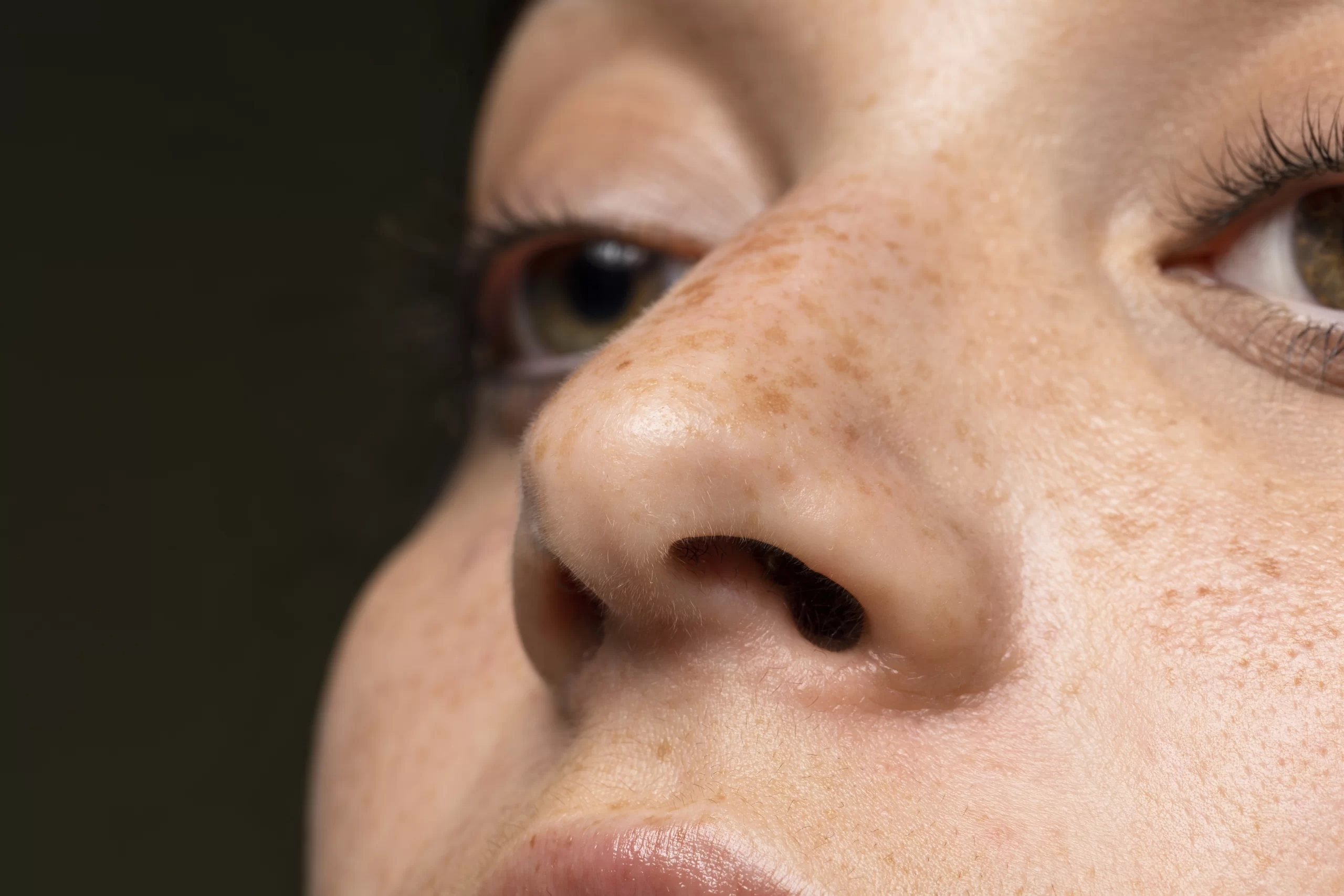 Pecas: causas, cuidados y tratamientos despigmentantes - Dermatología ...