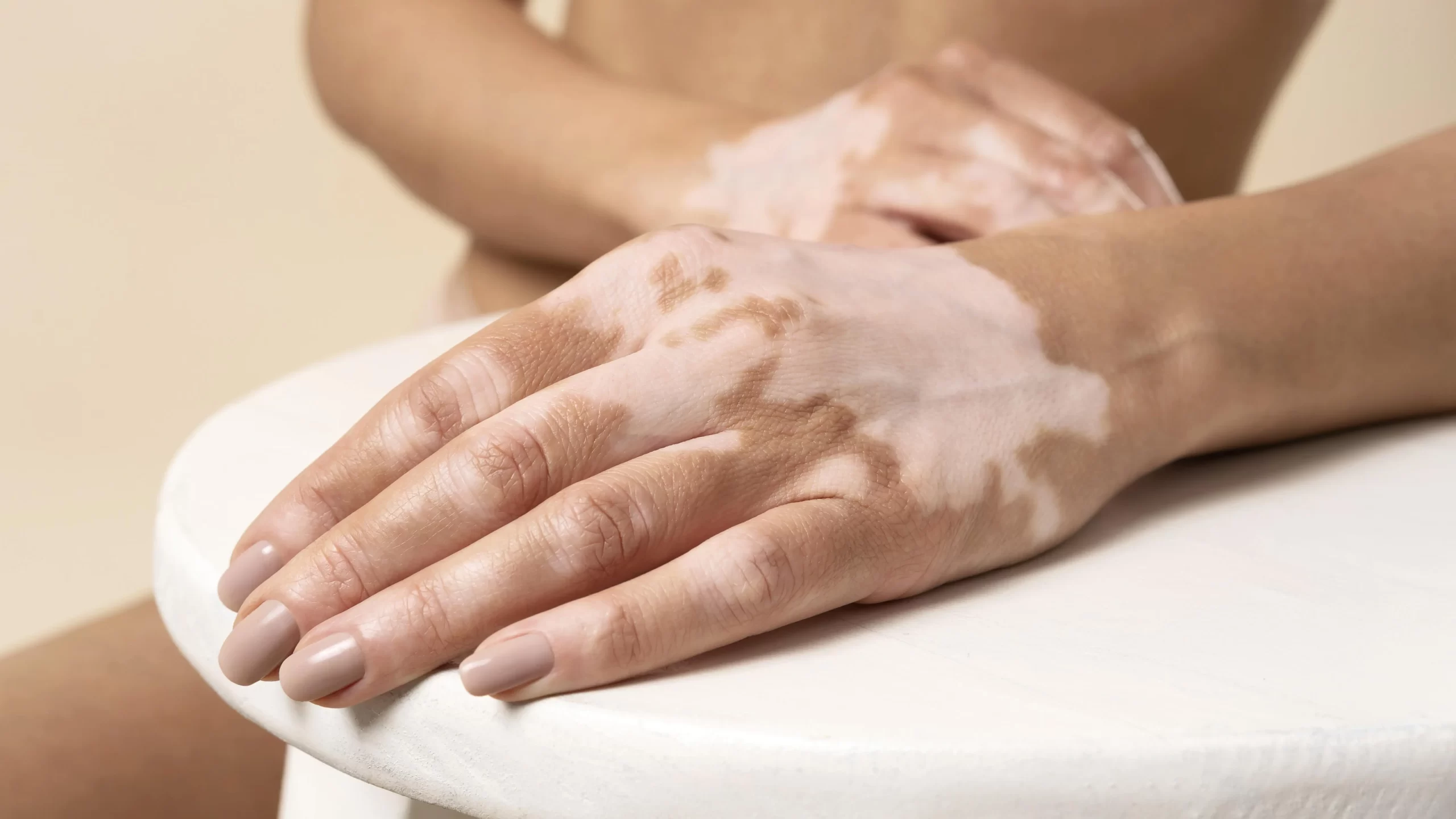 Vitíligo: tipos, causas y tratamientos - Dermatología Caracas Venezuela